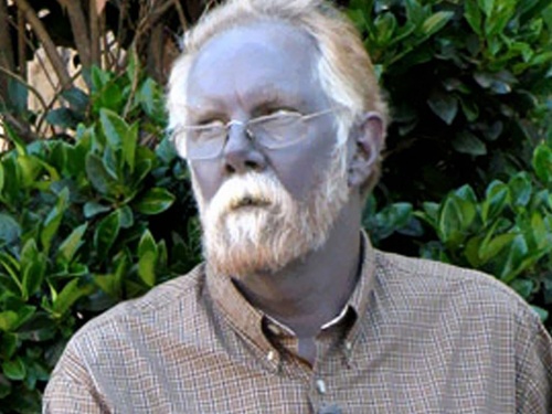 खाने से नशा, पानी से एलर्जी..दुनिया की अजीबोगरीब 5 बीमारियां